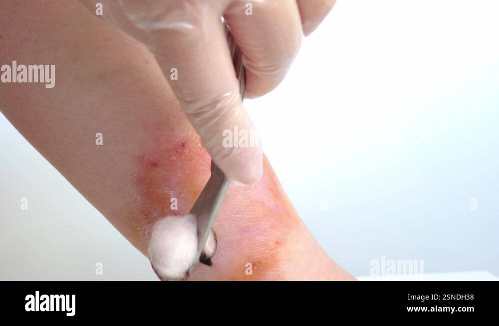 doctor's hands smearing medicine on damaged skin on female limb ...