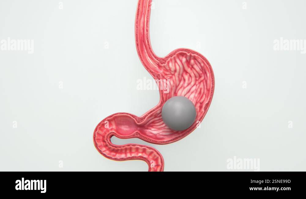 Balloon stomach Stock Videos & Footage - HD and 4K Video Clips - Alamy