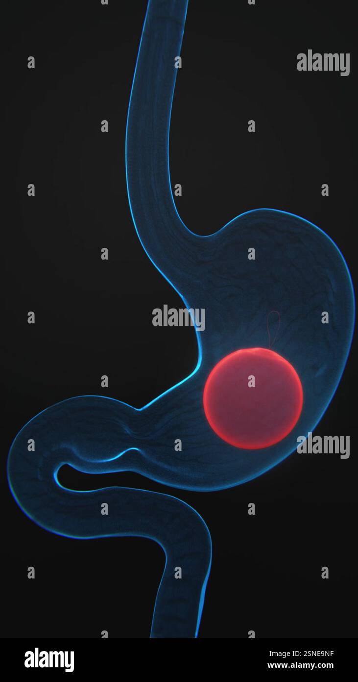 Gastric Balloon vertical video in X-Ray | Silicone balloon in the ...