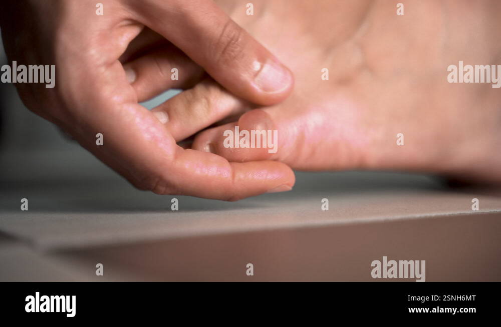 Blister on pinky toe. Inspection of Large Painful Blister on Little Toe ...