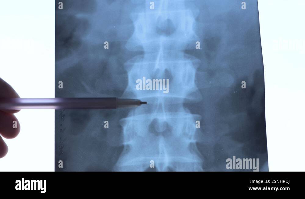 Healthy spine xray Stock Videos & Footage - HD and 4K Video Clips - Alamy