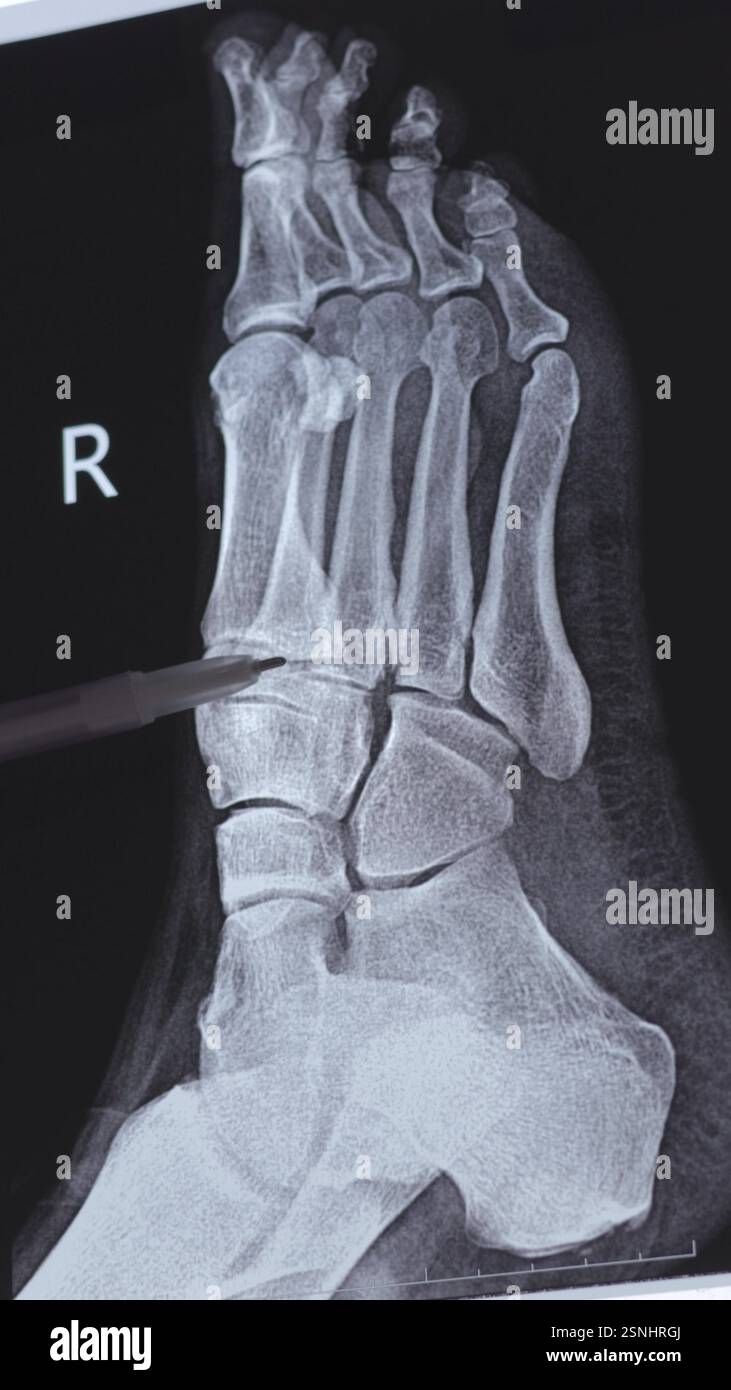 Treatment of Sprains and dislocations of the muscles and bones Stock ...