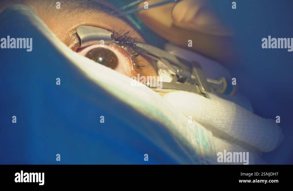 Ophthalmic procedure close-up showing laser surgery, lens implant ...