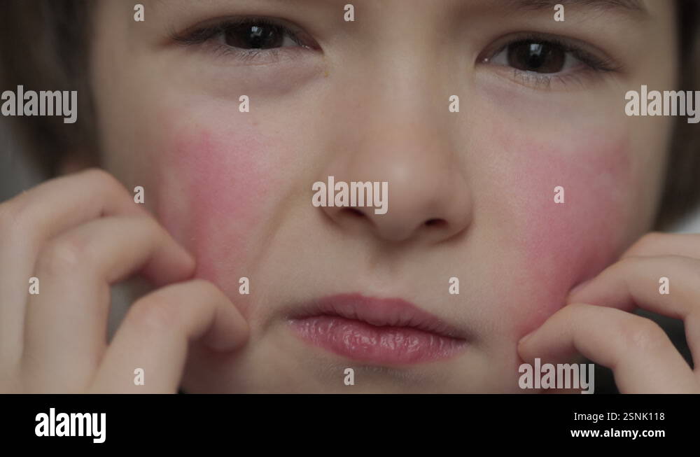Child Scratching Red Rash on Face. Boy Scratches Atopic Skin Stock ...