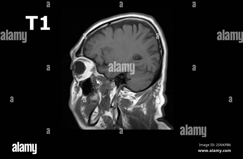 Normal brain mri scans Stock Videos & Footage - HD and 4K Video Clips ...