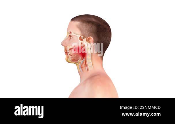 A medical illustration of a sore throat, showing inflammation, redness ...