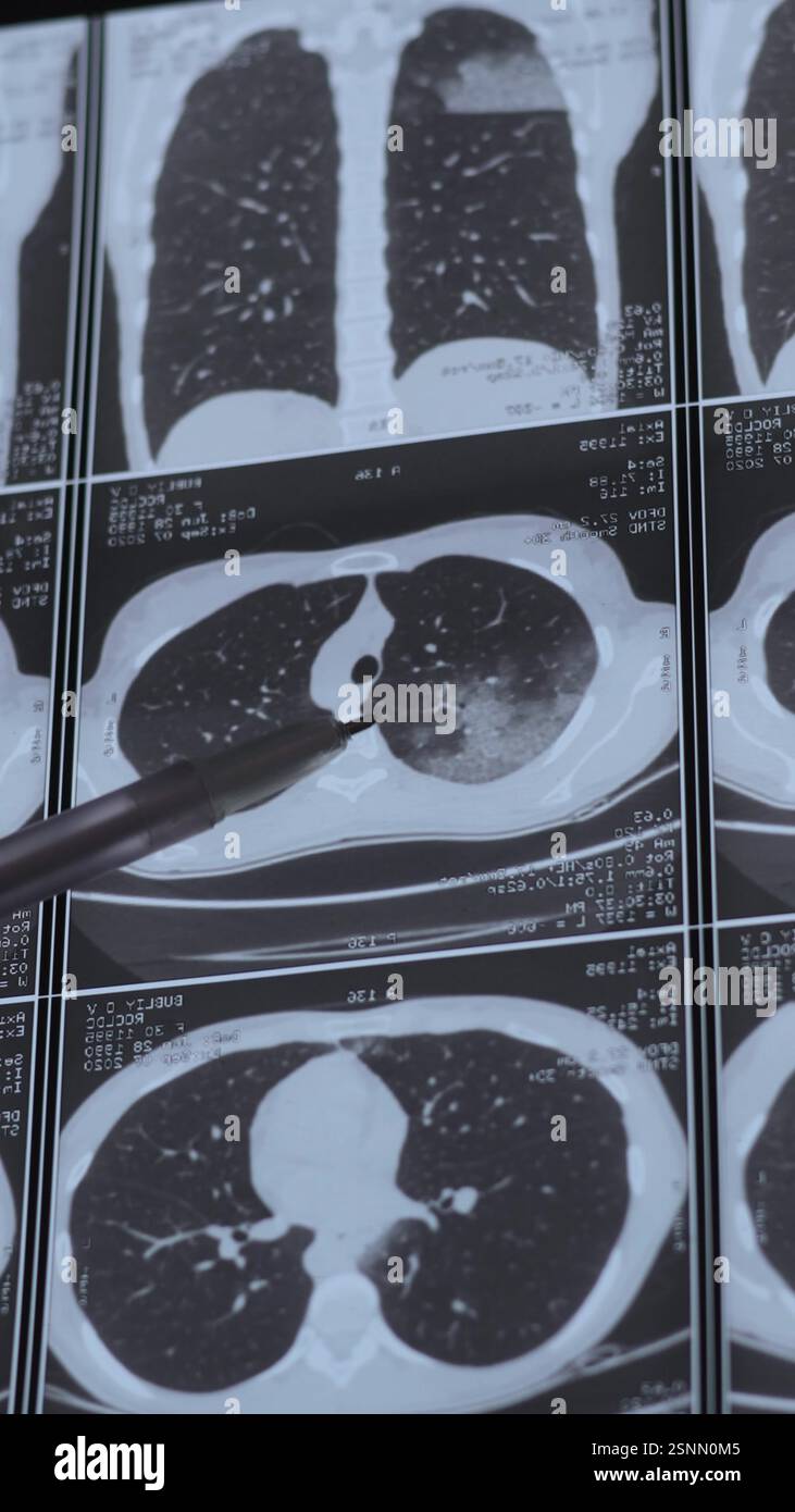 Lung scans Stock Videos & Footage - HD and 4K Video Clips - Alamy
