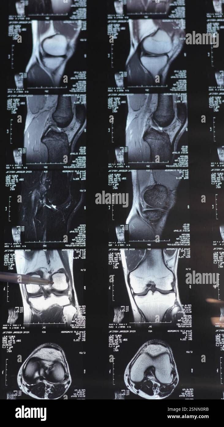 Knee joint MRI Stock Video Footage - Alamy