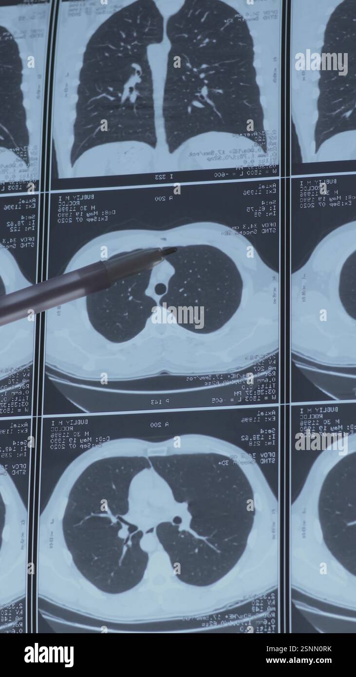 Diagnostic of vertical X-ray or MRI scan of human lungs Stock Video ...