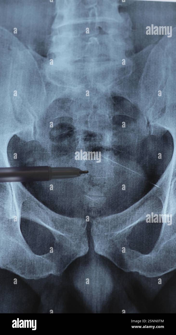 Doctor learn vertical MRI of Bones of the Lumbar Spine and Pelvis Stock ...