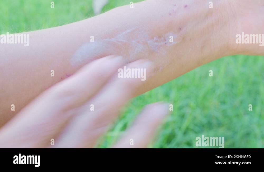 Woman apply calamine lotion , hand with urticaria allergy Itchy rash ...