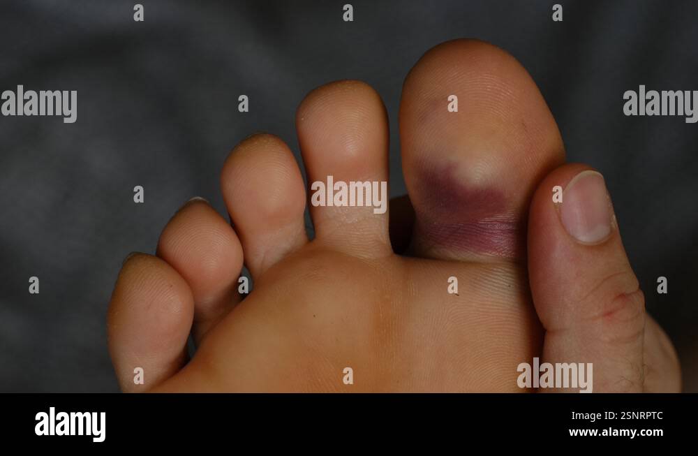Man displaying a worsening bruised toe with signs of swelling and ...