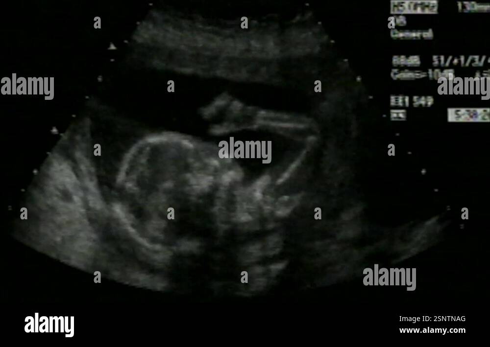 Sonogram Stock Videos & Footage - HD and 4K Video Clips - Alamy