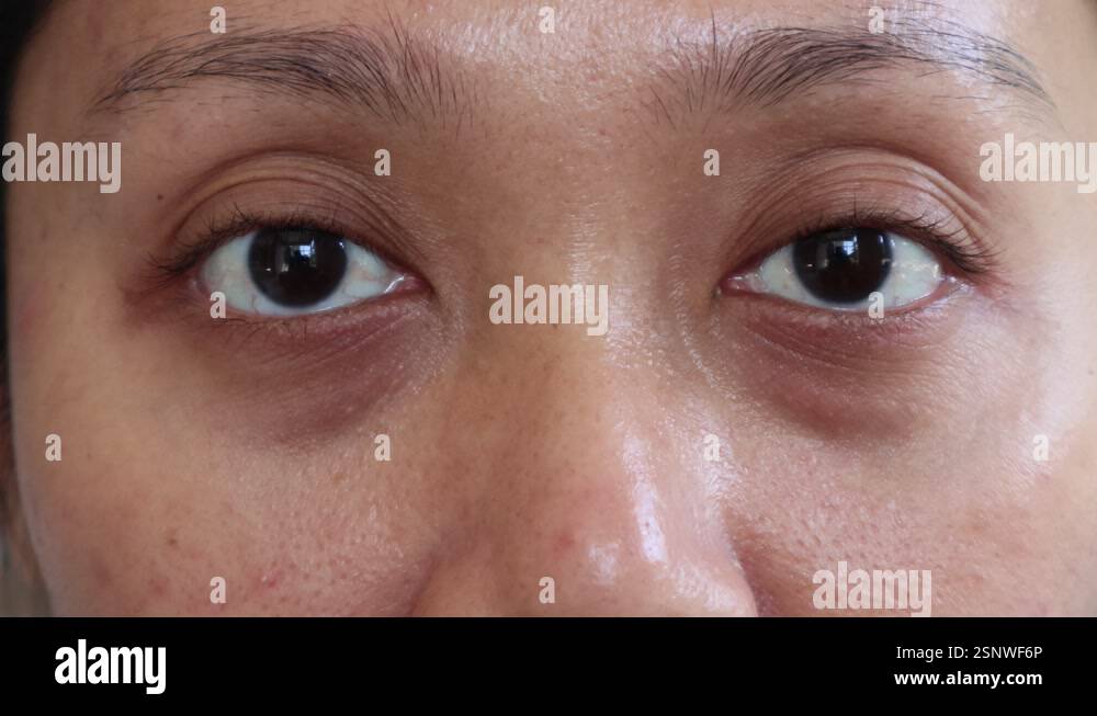 young woman face has dark bags under her eyes. Swelling of the lower ...