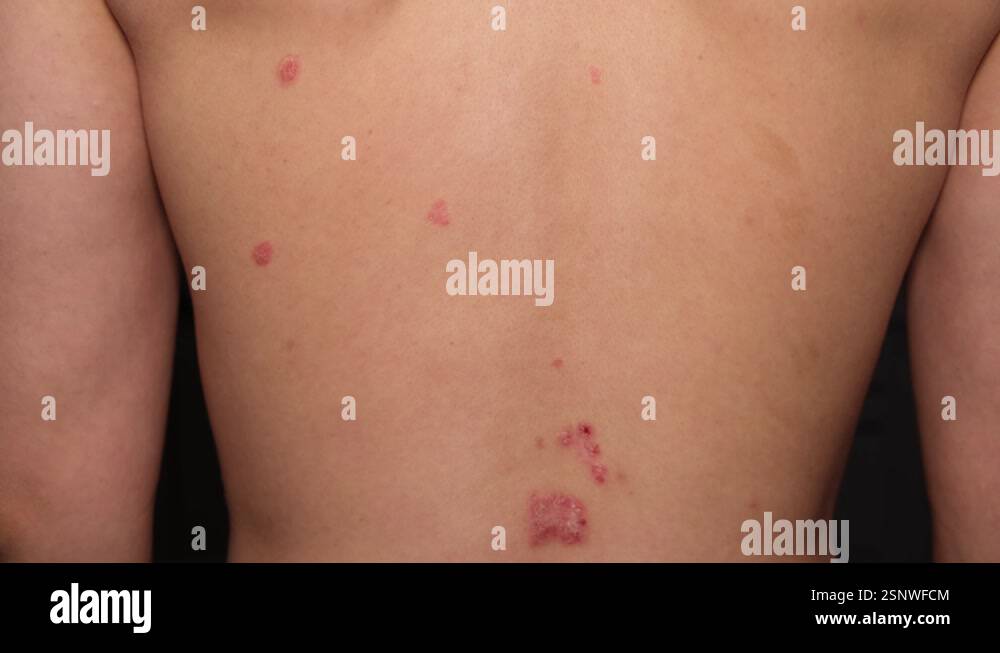 Understanding psoriasis symptoms and effects on the skin during a flare ...