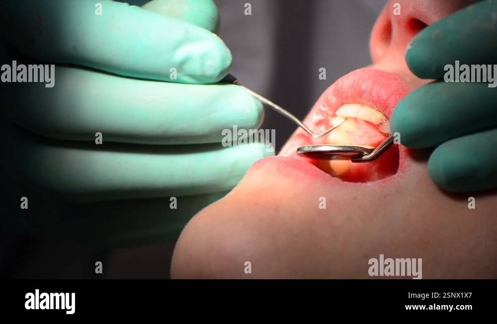 dentist check gum for gingivitis desease Stock Video Footage - Alamy