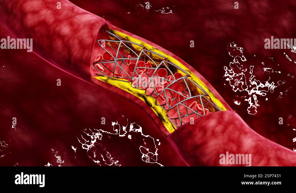 Artery cross-section with blood flow, fat plaque and stent deployment ...