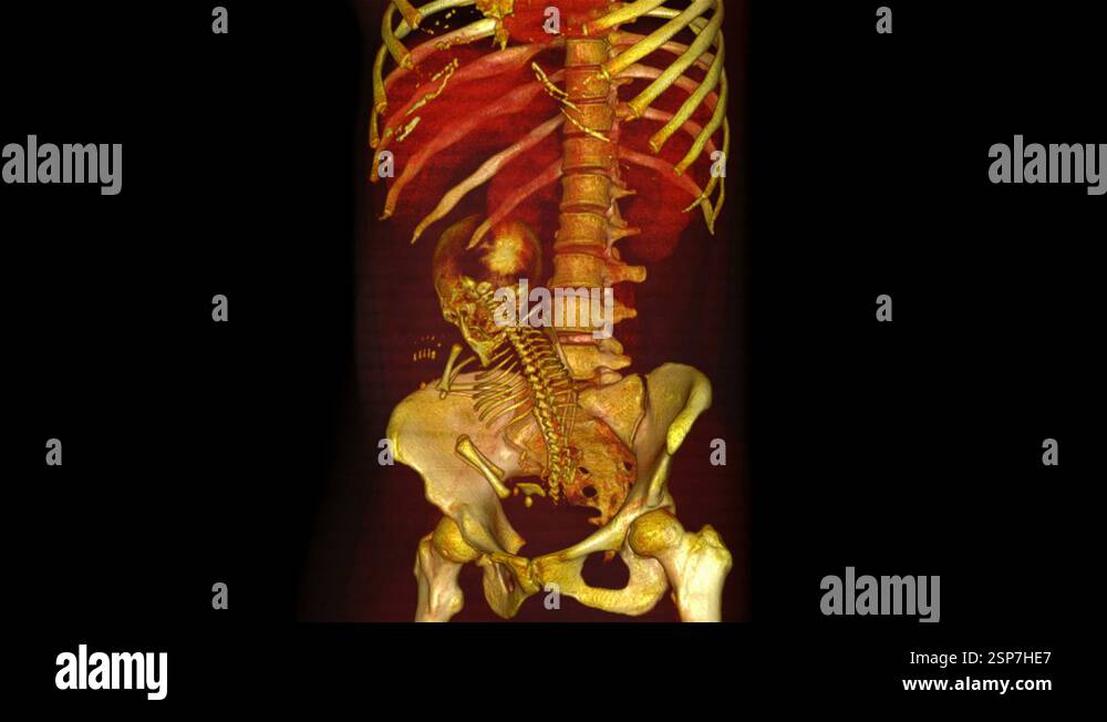 CT scan showing a full term human fetus Stock Video Footage - Alamy