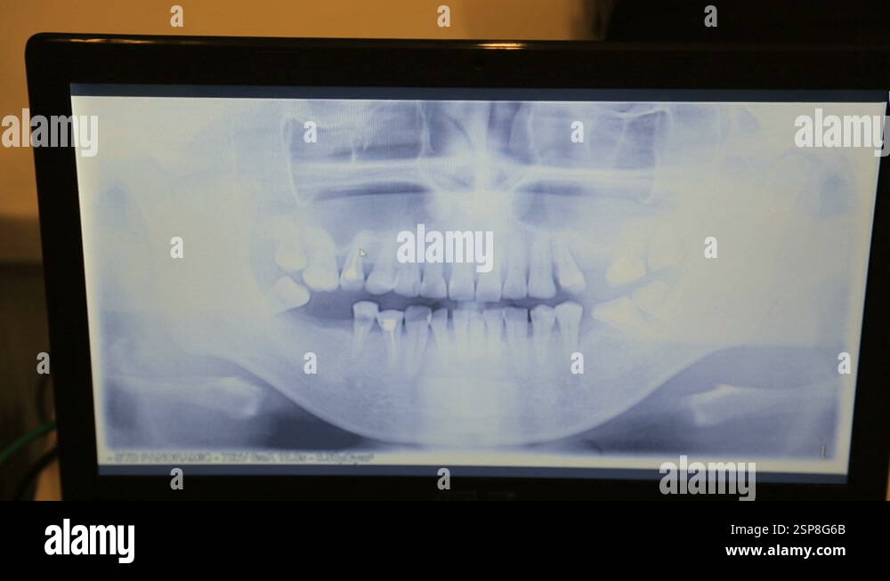 Computer screen shows a panoramic x-ray image of teeth and jaw Stock ...