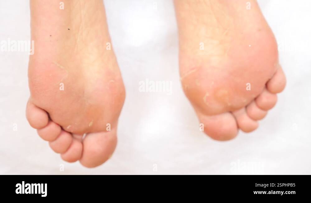 Female feet with skin peeling off. Foot peeling after the procedure. 4k ...