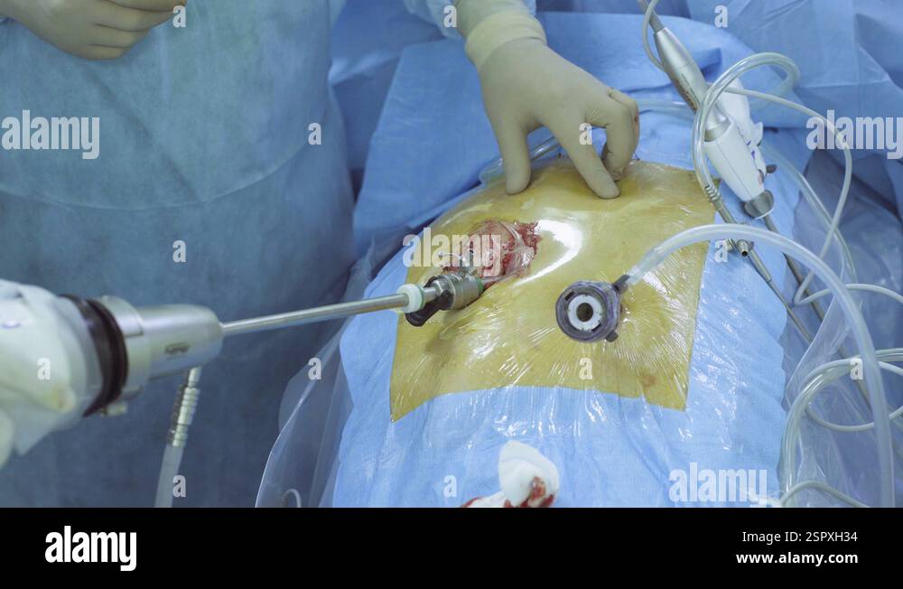 The surgeon making an incision on the abdomen Stock Video Footage - Alamy