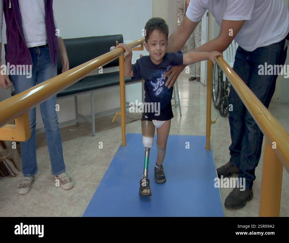 A father helps his young son take a step on a prosthetic leg using ...