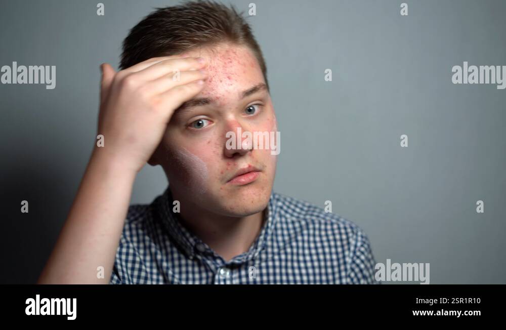 Man putting cream on his irritated face skin. Unhappy teenager taking ...