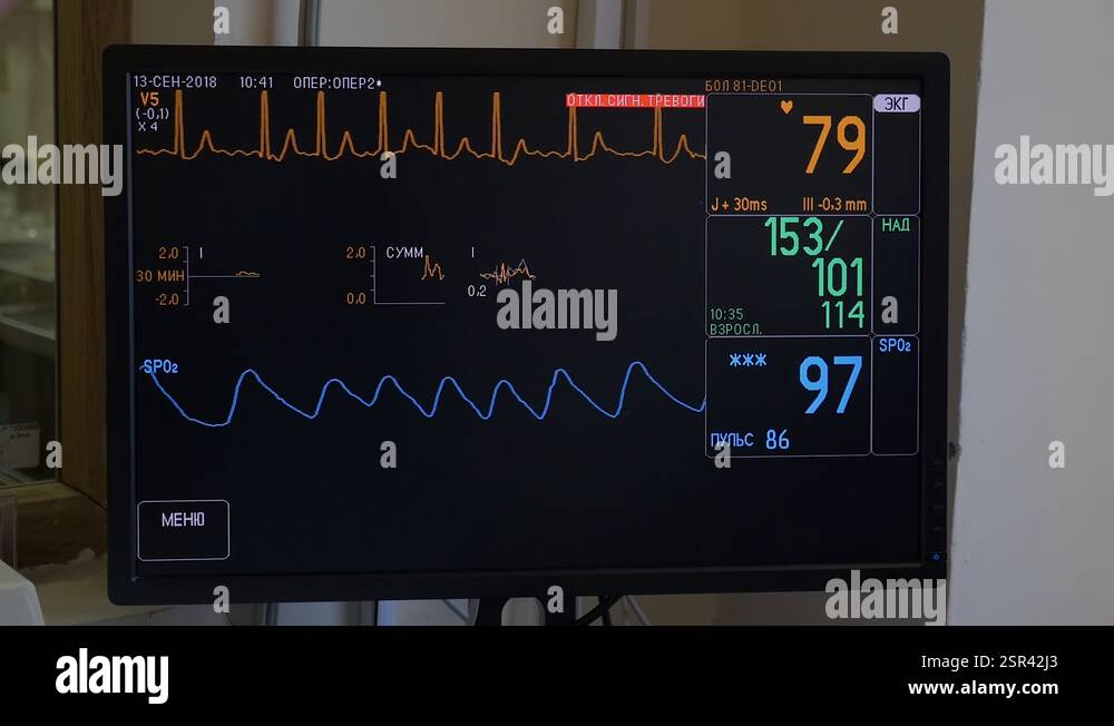 ECG monitor, shows the patient's condition in the operating room Stock ...
