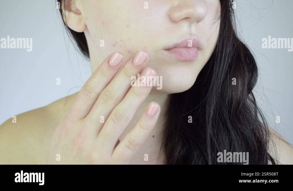 Brunette girl applies acne cream on face. Her cheeks are covered with ...