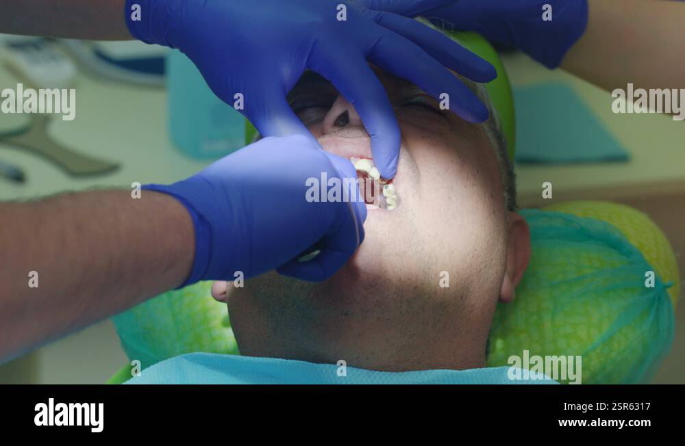 Teeth implant deinstaletion process. Close up dentist hands removing ...