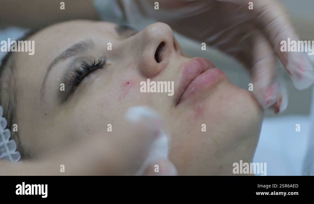 Cosmetologist at spa beauty salon doing acne treatment using mechanical ...