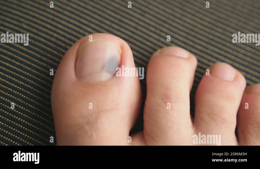 Sick nail. Trauma to the nail. Toes for legs. Bruise under the thumb ...
