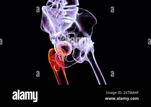 Intertrochanteric fracture of the right femur, 3D animation of pelvic ...