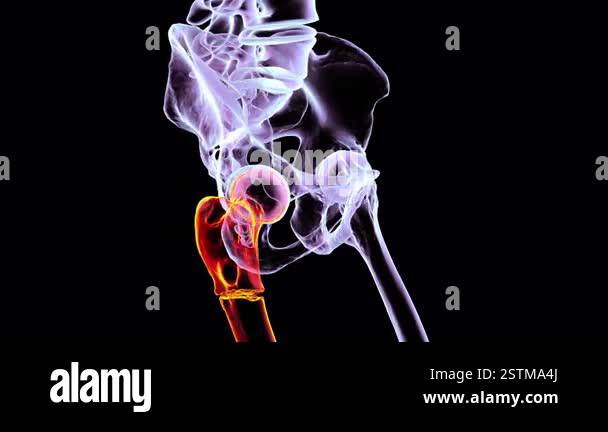 3D animation of pelvic bones with a subtrochanteric fracture of the ...