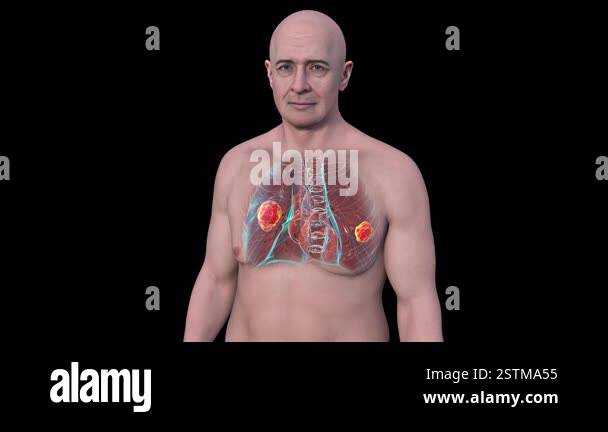 Lung mucormycosis, 3D animation showing fungal infection caused by ...