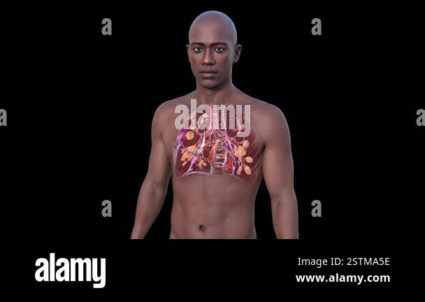 A man with lungs affected by cystic fibrosis, a genetic disorder ...