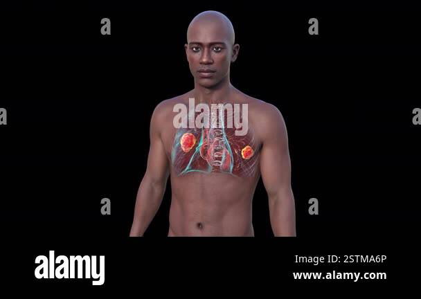 Lung mucormycosis, 3D animation showing fungal infection caused by ...