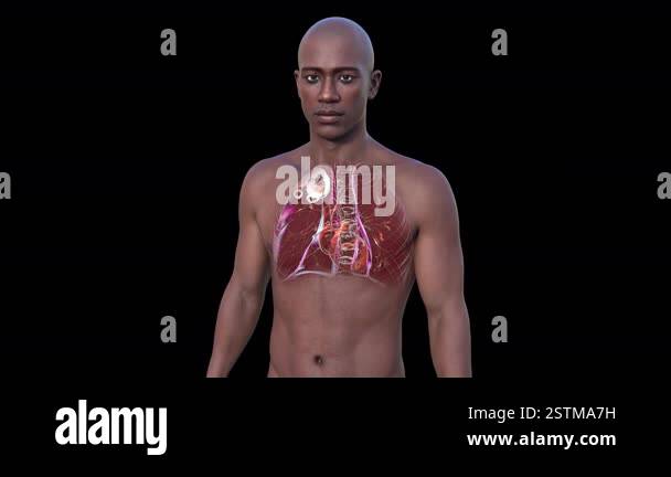 A man with lungs affected by cavitary tuberculosis in the upper lobe of ...