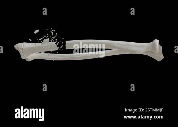 Forearm bone breaking to pieces with osteoporosis disease, isolated on ...