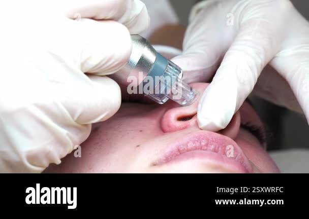 Young woman receiving hydra facial treatment for exfoliation ...