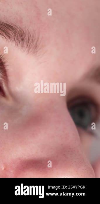 Large clearly visible pores on a girls nose in a cosmetology ...