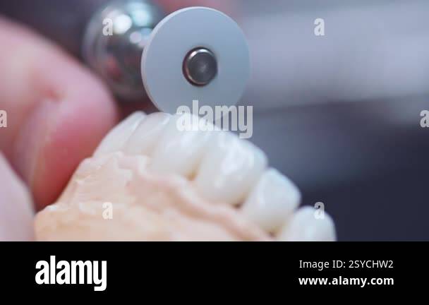Close up man dentist hands setting dental tooth crown on jaw model ...