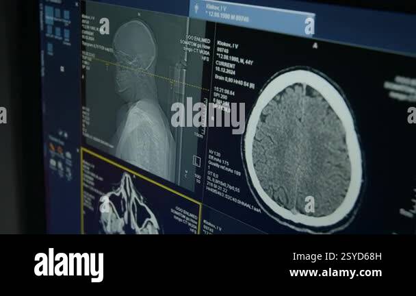 Panning closeup of computer screen with MRI scan of patient brain and ...