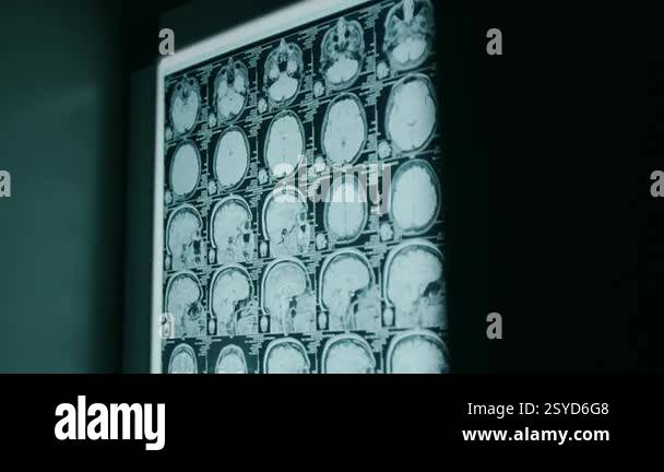 No people close-up of patient brain MRI scan on film, viewed on light ...