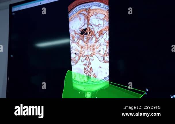 Aortic dissection mri Stock Videos & Footage - HD and 4K Video Clips ...