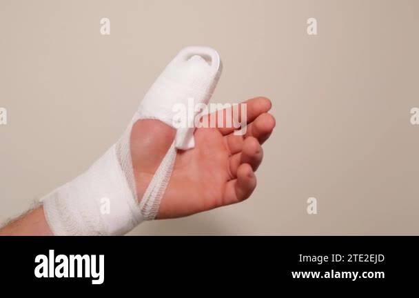 White bandages and a splint on the arm.Broken arm.Bandage and splint on ...