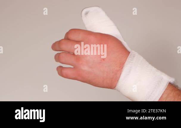 bandages and a splint on the arm .Broken arm.Bandage and splint on the ...