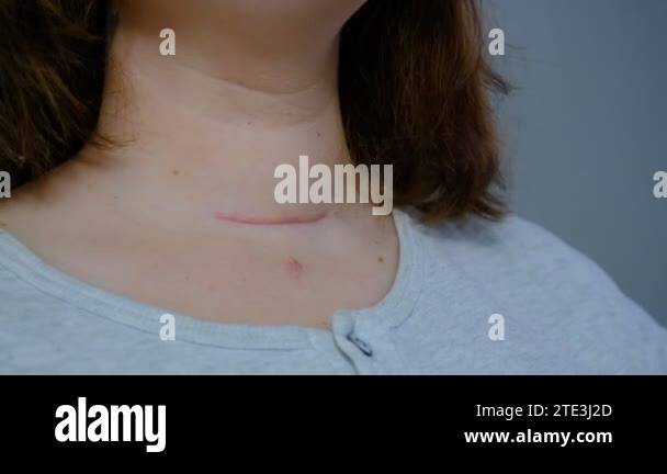 Scar on the neck. surgical wounds, removal of tumor and thyroid cancer ...