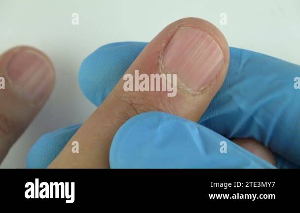 Vertical ridges on the fingernails symptoms deficiency vitamins and ...