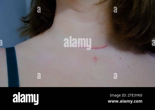 Scar on the neck. surgical wounds, removal of tumor and thyroid cancer ...